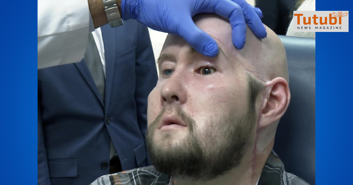Landmark surgery: World's first whole eye transplant offers hope ...