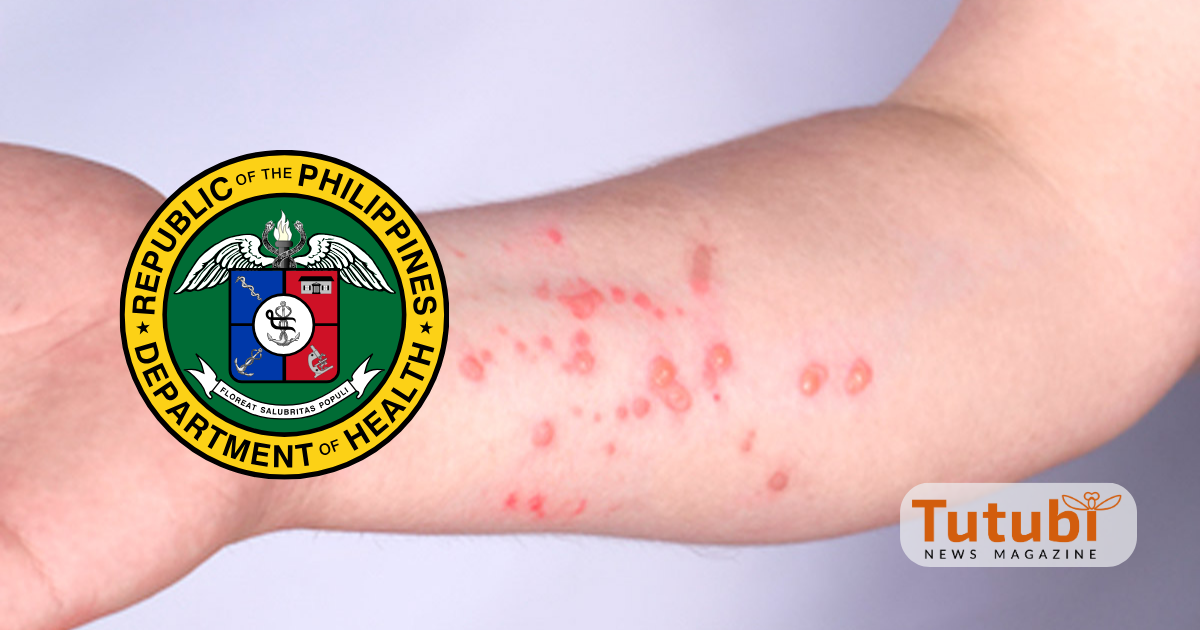 DOH mahigpit ang pagbabantay sa Mpox Clade 1b - Tutubi News